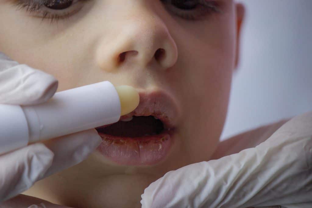 Why Are My Child’s Lips Always Chapped? - Between Carpools
